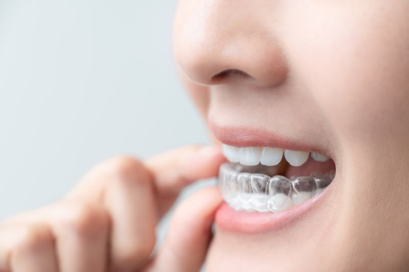 How to Easily Remove Your SureSmile® Aligners